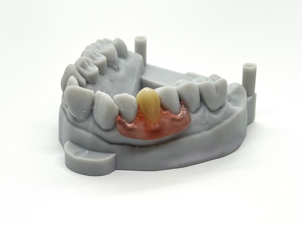 Flexible Nesbit to Finish with Model – GPS Digital RPD
