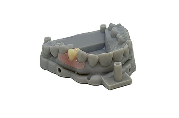 Flexible One Tooth Nesbit to finish with Model – GPS Digital RPD